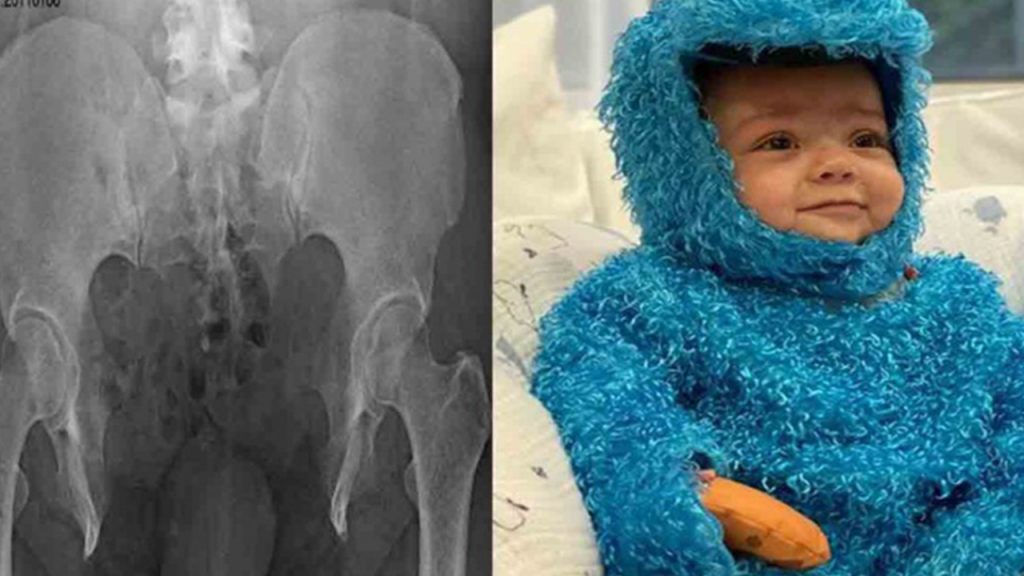 ¿Qué es la Extrofia Cloacal?, enfermedad que padecía el hijo de 'Sopitas'